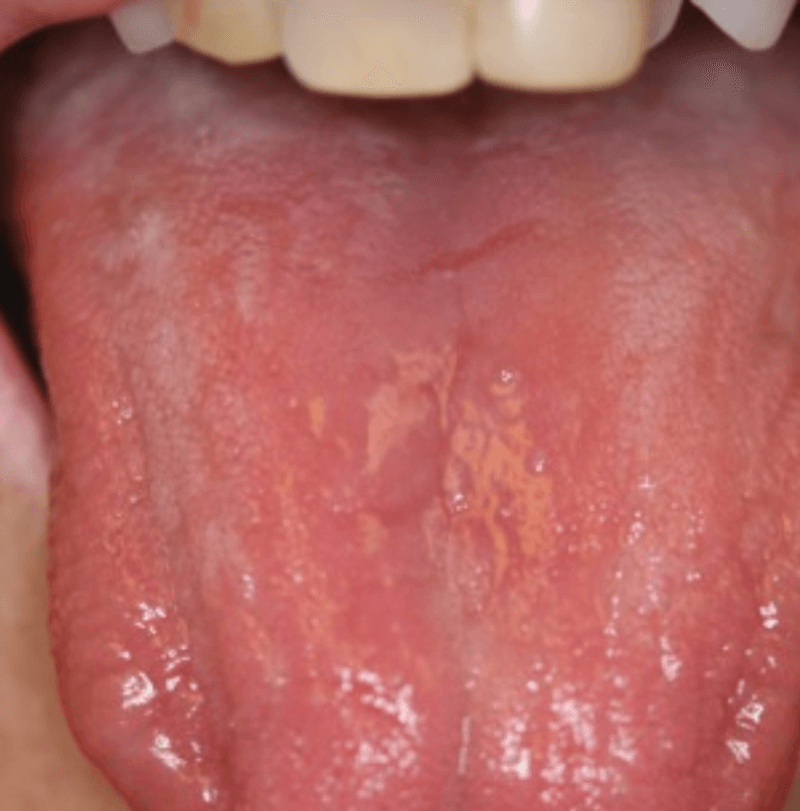 B12 Deficiency Tongue